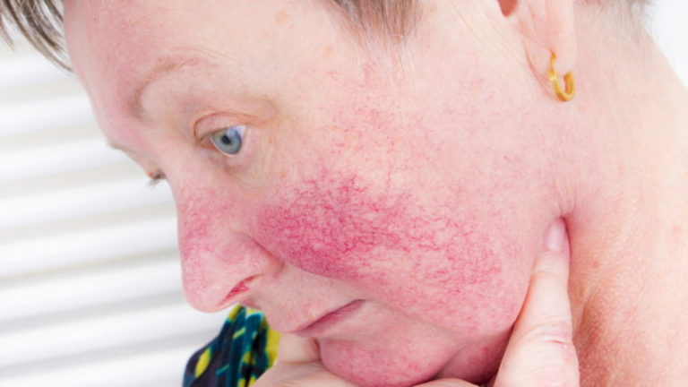 Rougeurs au visage: Causes, soins et traitement